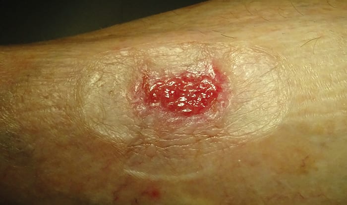 Como as feridas cicatrizam