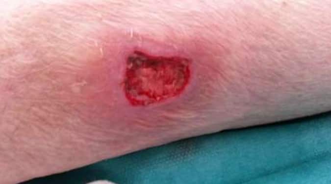 Tratamento de uma ferida traumática com hidrocoloides.